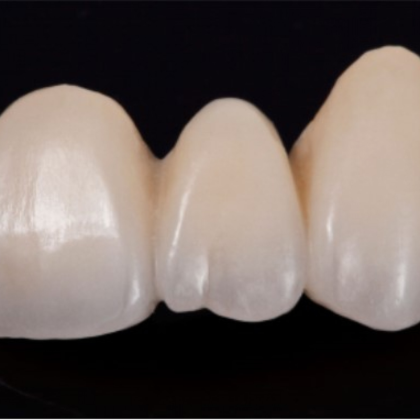 Metal Free Crown & Bridge | Utica, Syracuse, Schenectady, NY: Biogenic ...